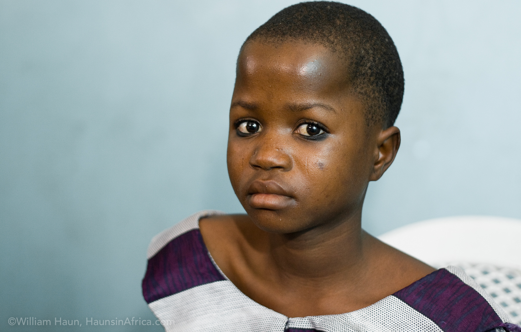 Scalp Hematoma - The Hauns in Africa